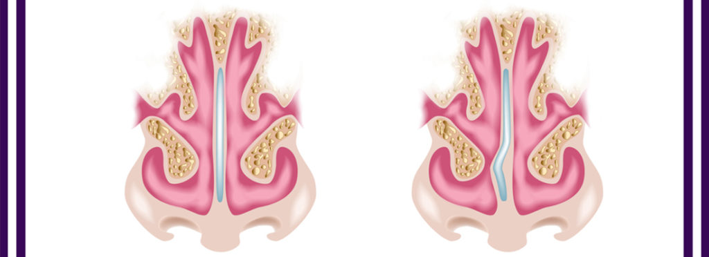 What is Septoplasty?